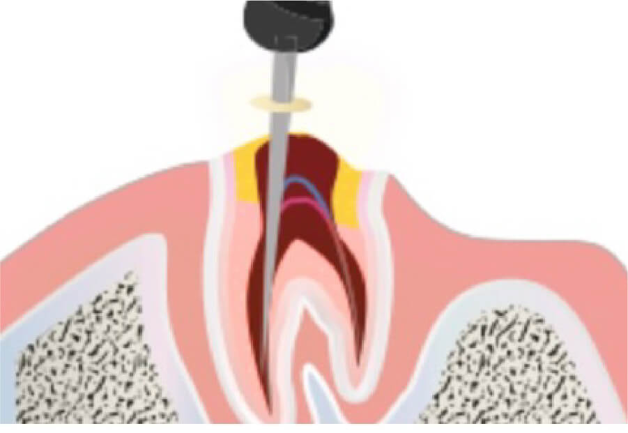 Root canal treatment - Nakamura Dental Clinic English