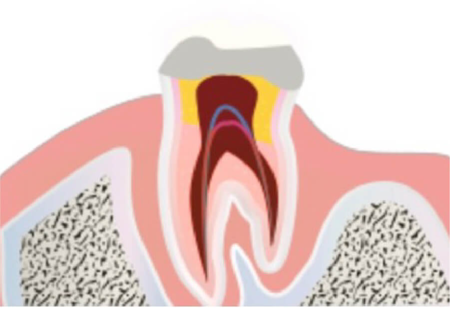 Root canal treatment - Nakamura Dental Clinic English