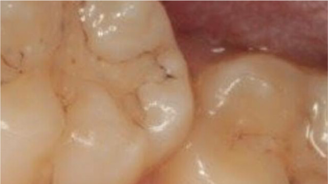 Insect teeth treatment - Nakamura Dental Clinic English