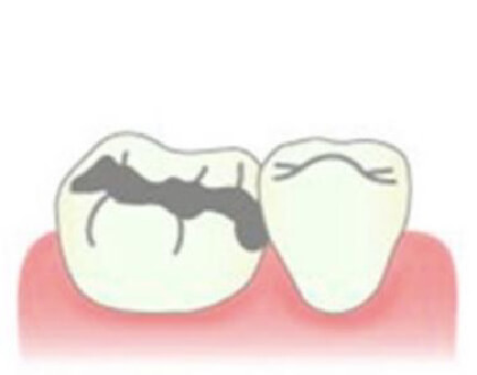 Insect teeth treatment - Nakamura Dental Clinic English