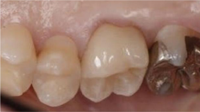 Insect teeth treatment - Nakamura Dental Clinic English