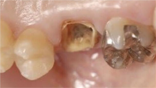 Insect teeth treatment - Nakamura Dental Clinic English