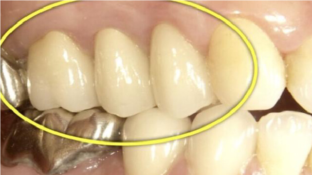 Insect teeth treatment - Nakamura Dental Clinic English