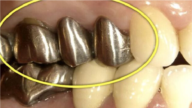 Insect teeth treatment - Nakamura Dental Clinic English