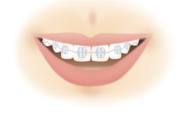 Orthodontic Treatment - Nakamura Dental Clinic English
